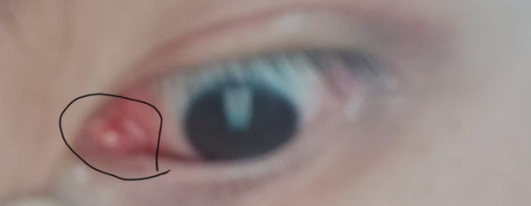 눈 가장자리 caruncle 간지러움 : 지식iN