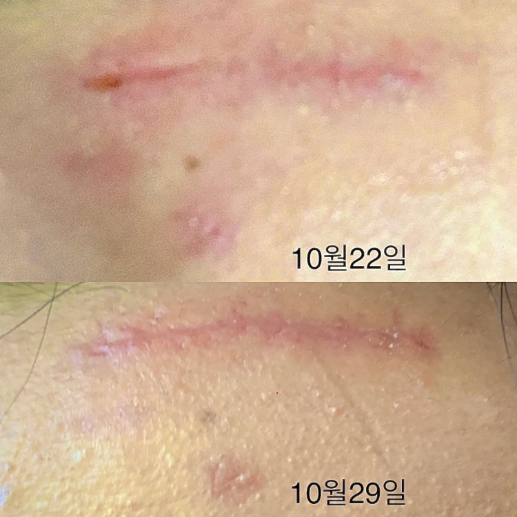 이마 봉합 실밥 제거 후 흉터 어떻게 관리해야하나요 지식in
