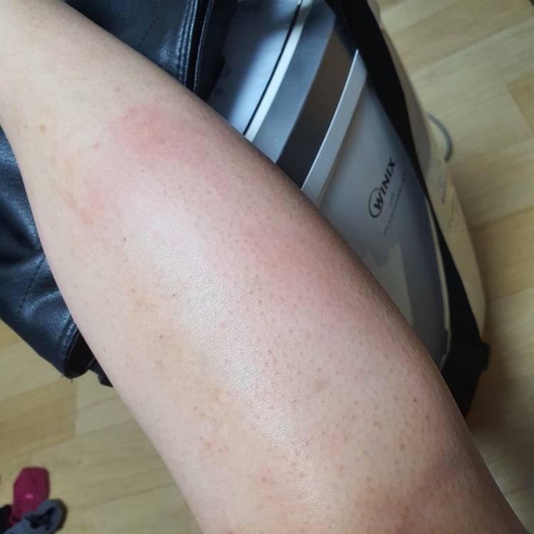 다리에 갈색 점들 다리 두드러기 가려움 이유좀ㅠㅠ 지식in