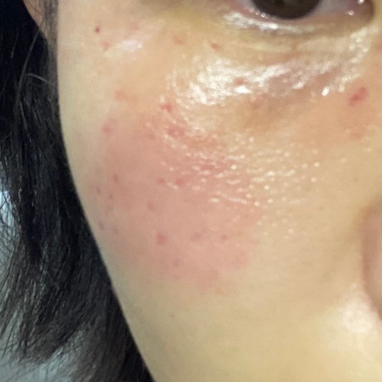 주근깨 레이저시술 후 패임 지식in