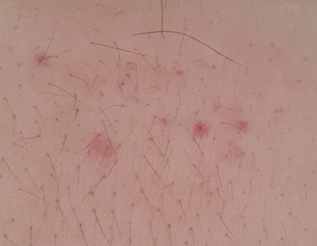 이거 혹시 집먼지 진드기 물린자국인가요 지식in