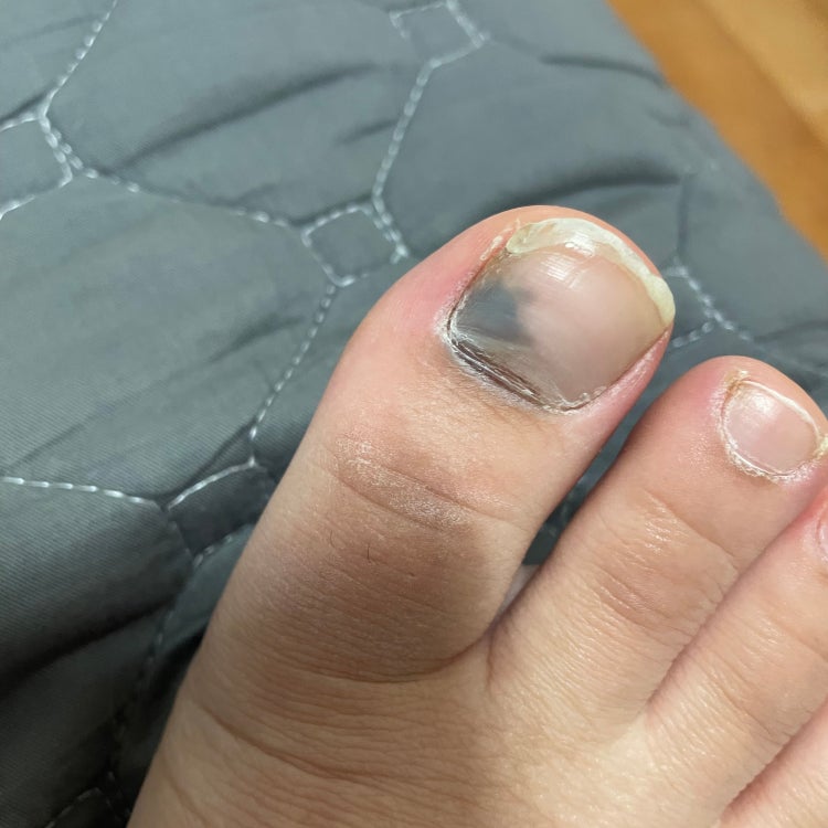 발톱에 이렇게 검은 점 같은 게 생긴 지식in