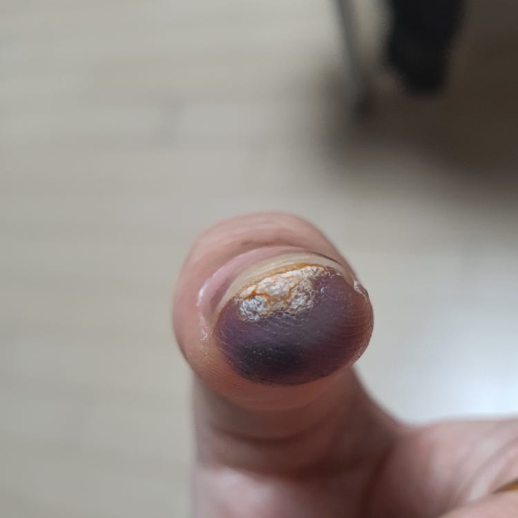손가락 사마귀 1차 냉동치료 했는데 앞으로 몇 번 더 해야할까요 사진주의 지식in