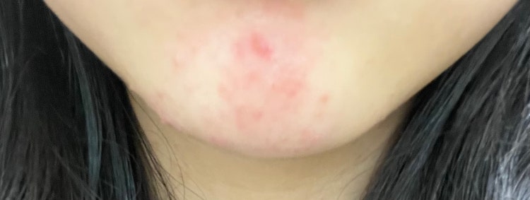 턱 밑에 여드름이 많이 났어요 지식in