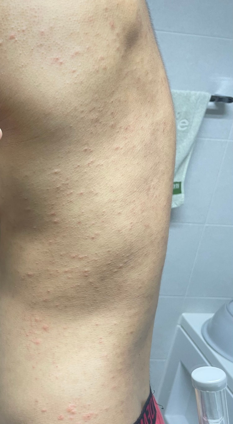피부 아토피 발진 질문 사진 첨부 환공포증 주의 지식in