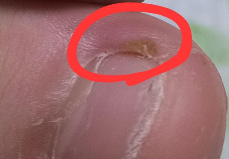 어제봤는데 왼쪽 엄지발가락 부분에 노란색깔 고름이 차있고 살짝 부었어요 제가 발톱을 뜯긴하는데 아래 지식in