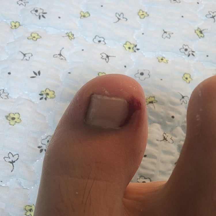 내성발톱 자르다가 잘못 잘랐는지 고름 생기고 부었어요 지식in