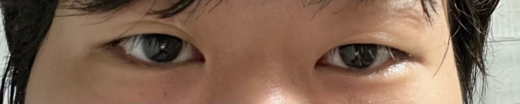 남자 쌍커풀 수술 사진 지식in