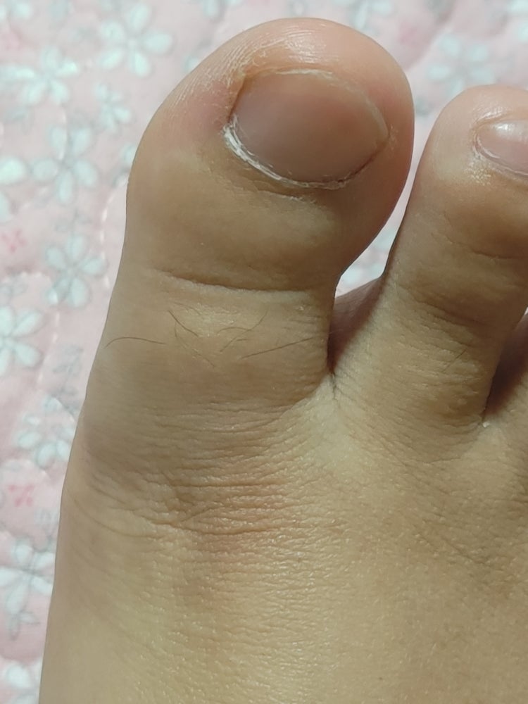 엄지발가락 부음 지식in