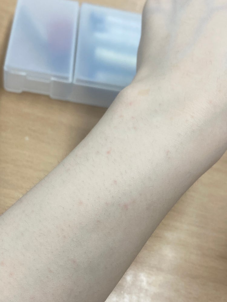 제가 알바할 때 고무장갑 끼고 설거지 해서 이런 피부 트러블이 났습니다 지식in
