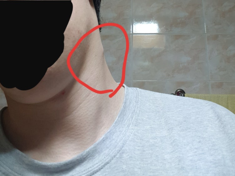 목 옆에 혹 이거 뭔가요 지식in