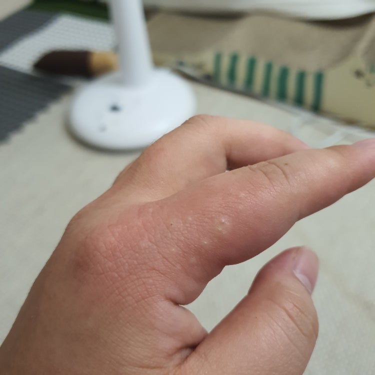 피부 질환 : 지식iN