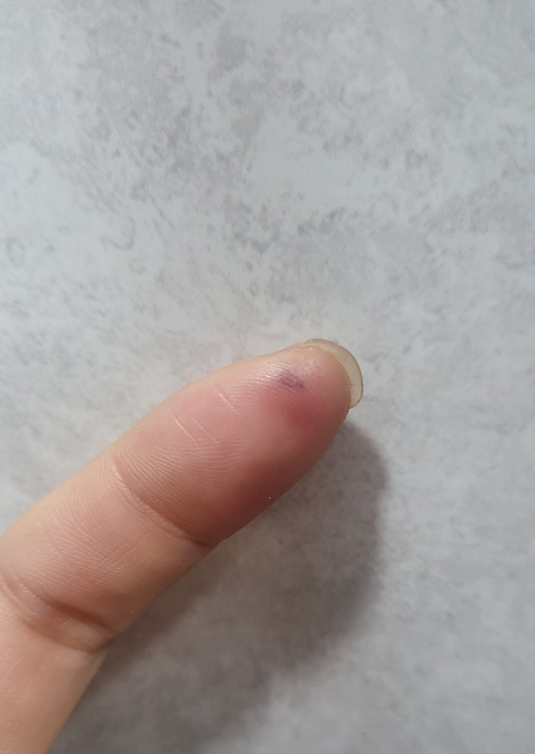 왼손검지손가락에 이런게 있는데한 이틀정도 욱신거리면서 신경쓰이더니 3일째 되면서 눈에 띄는 색으로 변하고 여전히