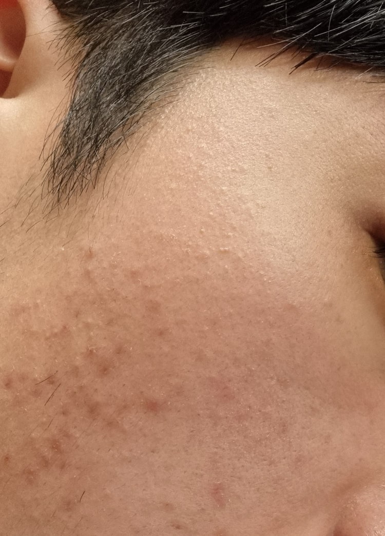화장품 잘못써서 피부가 이렇게됐는데 어떻게 해결해야할까요 지식in