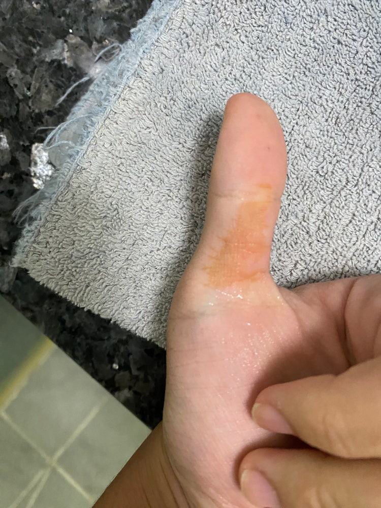 자고일어났는데 손에 갈색무늬가 생겼어요 이게 뭔가요 지식in