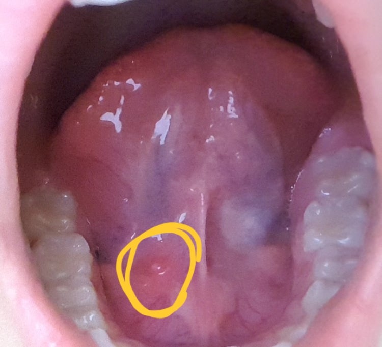 혀 밑 흰 염증? (사진첨부) : 지식iN