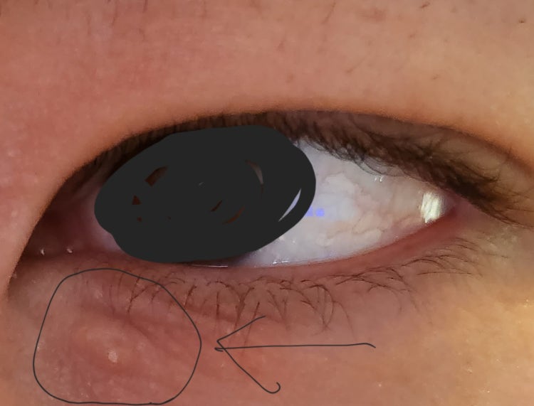 눈 밑 동그란 지방 주름 갑자기 생겼는데 어캐 없애나요 지식in