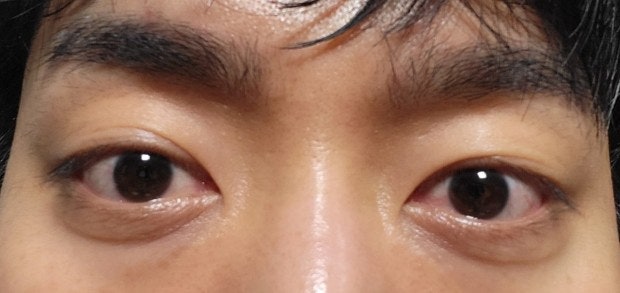 남자 쌍수 속쌍 할려고 하는데 고민이 있어요 지식in