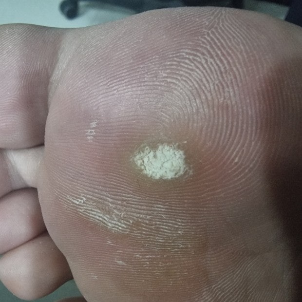 사진有 발바닥 티눈 제거 지식in