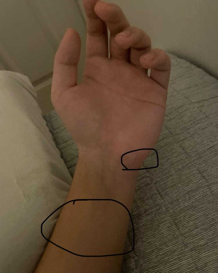 tfcc,손목터널증후군에 대해 : 지식iN