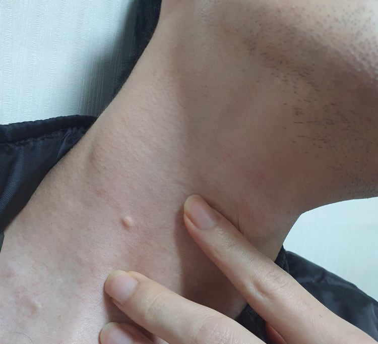 목에 부종 혹 같은게 나있는데 뭘까용 지식in