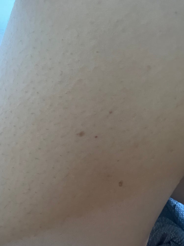 며칠 전에 벌레한테 물린건지 뭔지 두 세번째 발가락이 붓기 시작했어요 가려웠고 엄청나게 부었어요 그래서 지식in