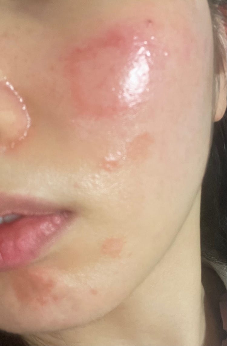 얼굴 흉터 붉은자국 지식in