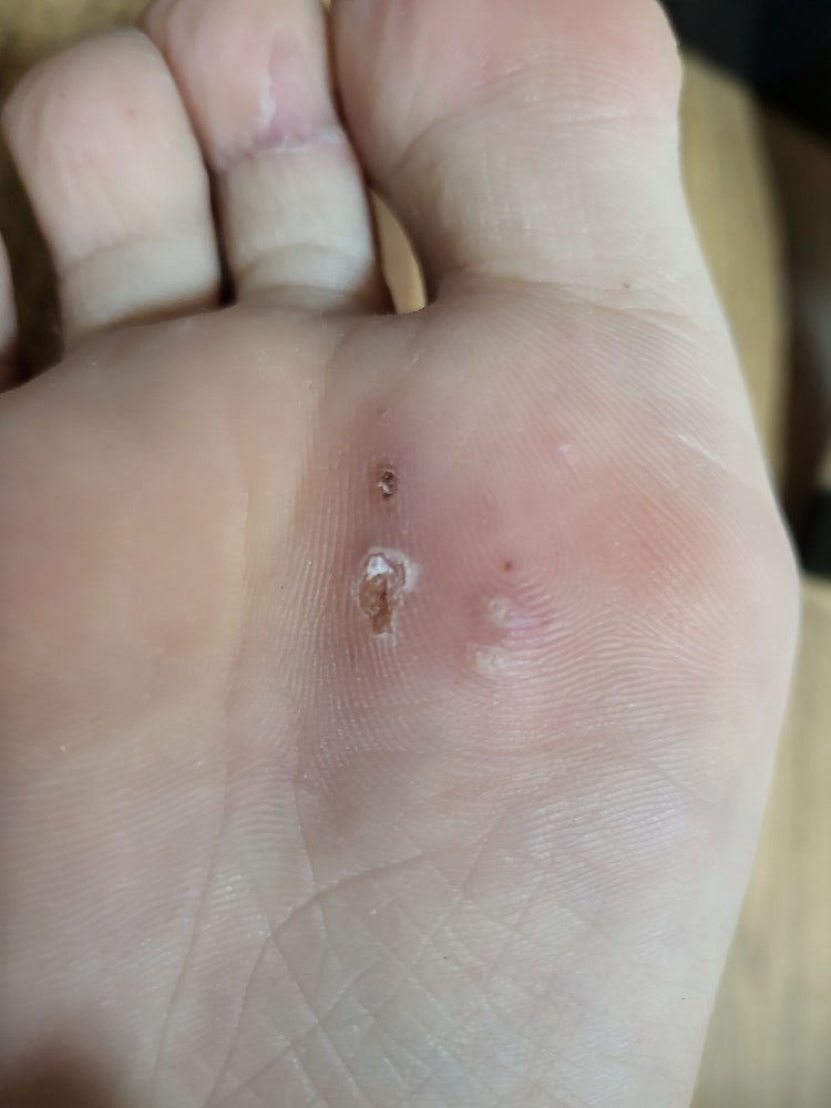 발바닥에 티눈인지 사마귀인지가 났는데 걸으면 아프고 누르면 아파요 원래 하나만 있었는데 며칠전에 3개가 더 났네요 티눈인지