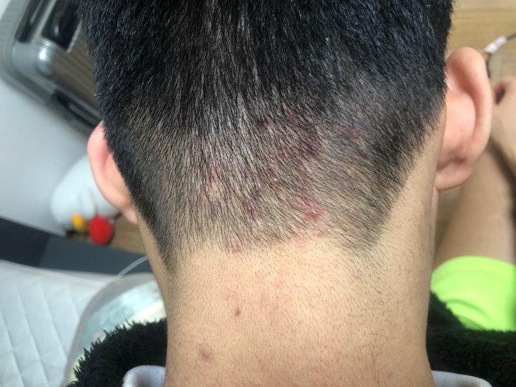 목 뒤에 여드름 : 지식iN