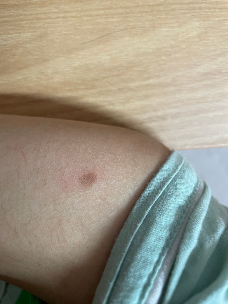 갑자기 생긴 점 지식in