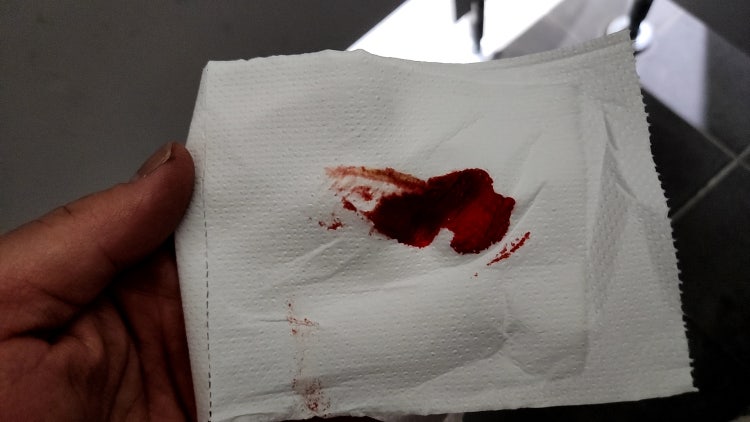ㆍ대변을 본 후 뒷처리 할때 피가 묻어나와요 ㆍ대변을 볼때는 피가 나오지않아요 ㆍ뒷처리할때도 출혈량이 그날마다 달라요 ㆍ속이