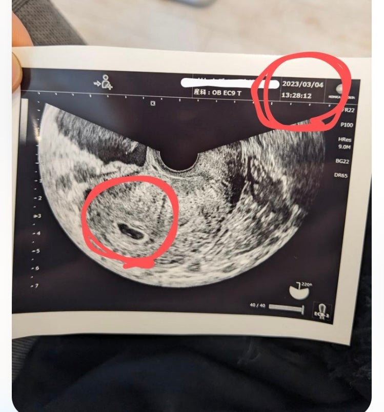 아기집및 초음파사진 지식in