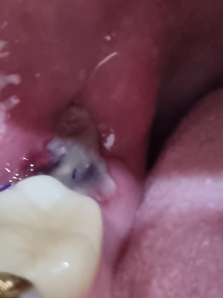 충치때문에 임플란트 하려고 발치 했는데 하얀부분이 염증인지 궁금합니다 지식in