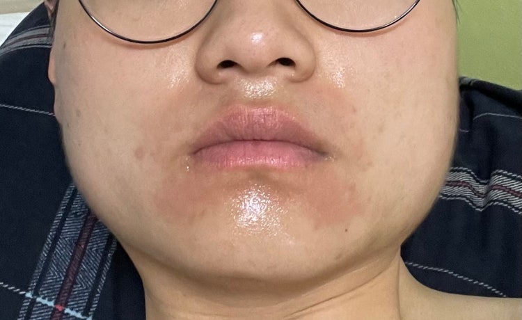 남자 입주변 붉은기색소침착 지식in