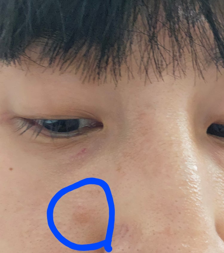 락티손에이취씨 바르고 색소침착 같은게 생겼는데 자연치유될까여 지식in