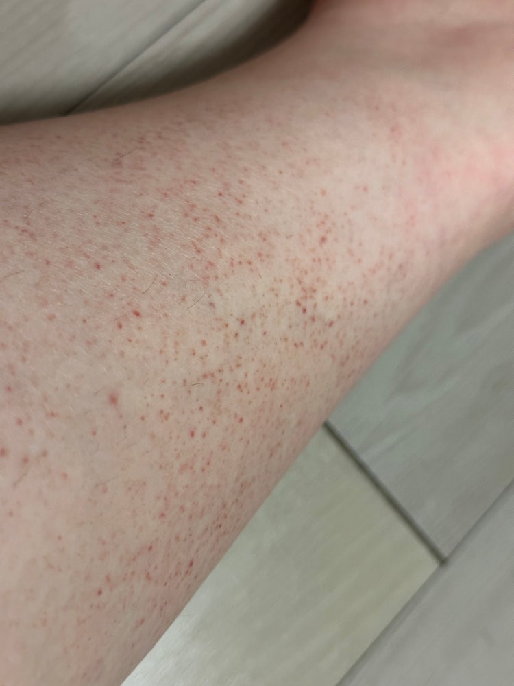 다리에 빨간 점과 종아리 쥐 지식in