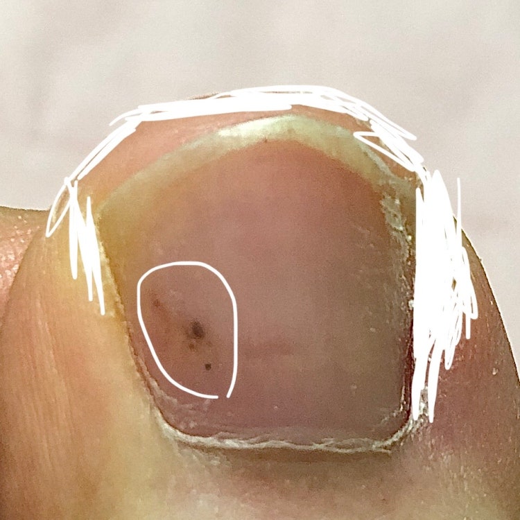 엄지발톱에 검은색 점이 있어요 지식in