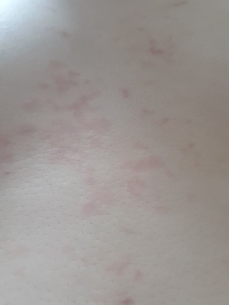 피부붉은점 지식in