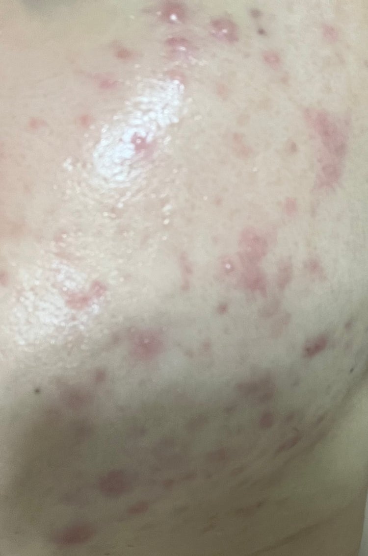 피부과 치료 관련 질문드립니다 사진첨부 지식in