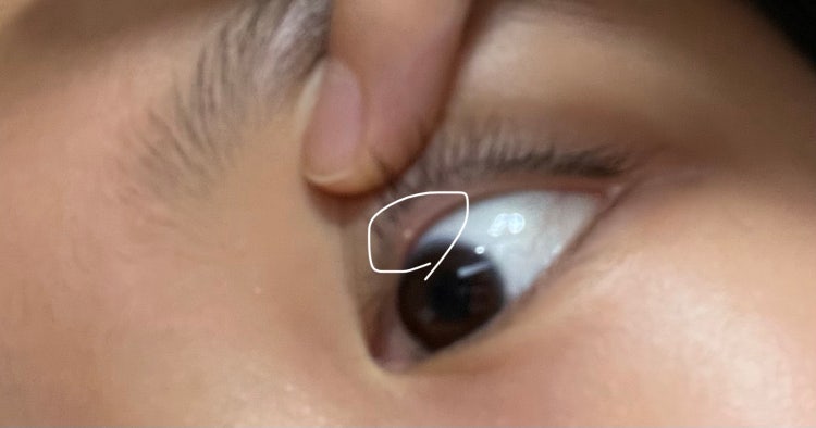 눈에 조그만한 알갱이같은게 지식in