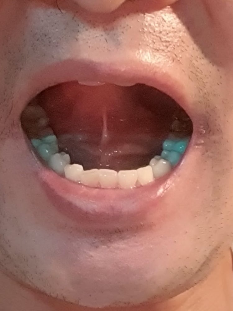 혀밑 오른쪽 부었어요~~ : 지식iN