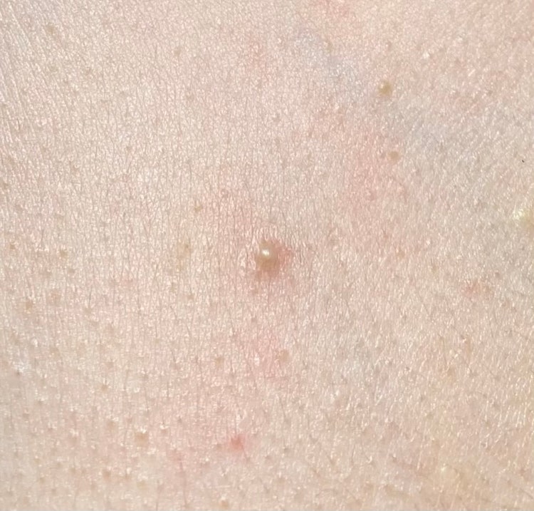가슴부근 트러블 왜 안없어질까요 지식in