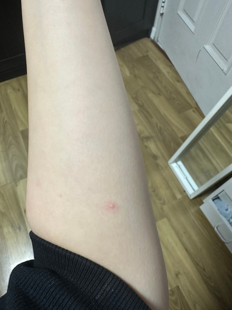 피부 발진 지식in
