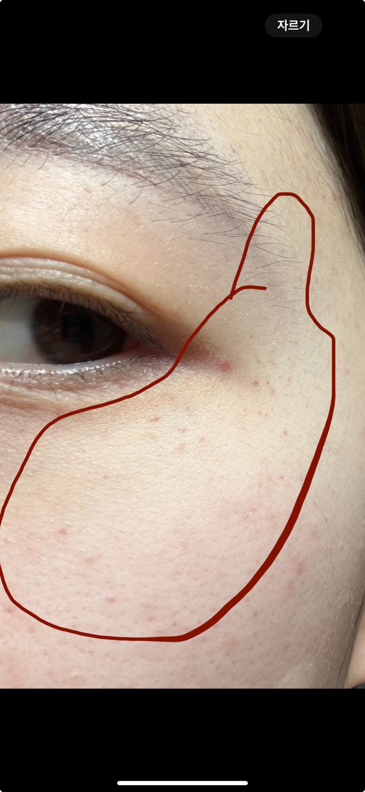 눈 주위 피부에 알러지가 생긴거 같아요 : 지식iN