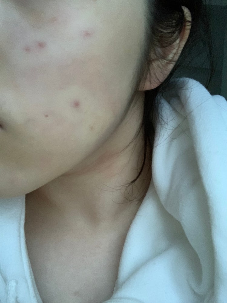 스테로이드 부작용 지식in