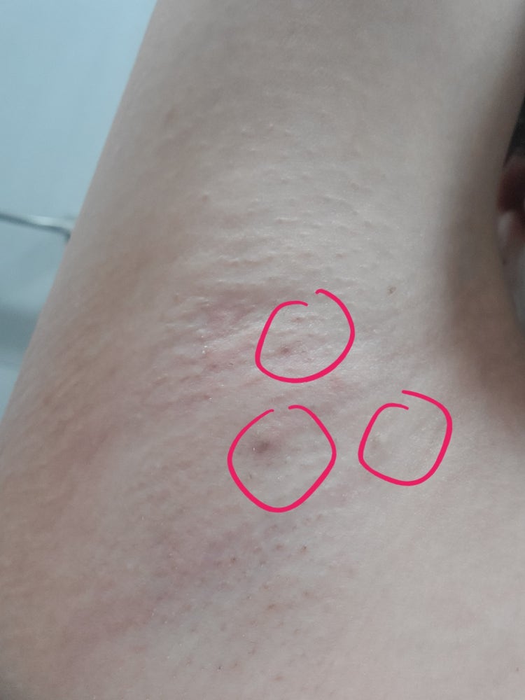 겨드랑이 피지낭종 지식in