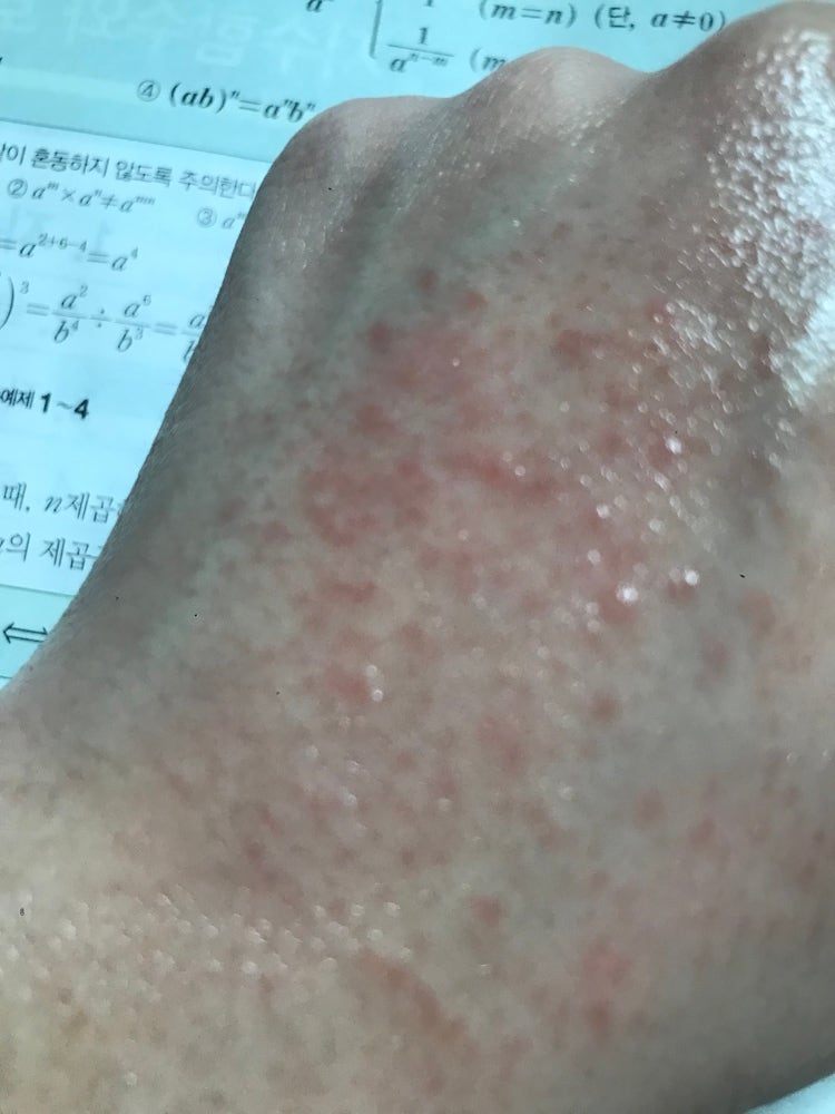 손등 두드러기 : 지식iN