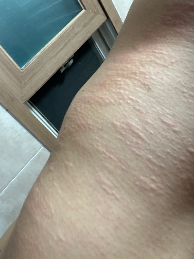 감각 이상 두드러기 찌르는 듯한 통증 지식in