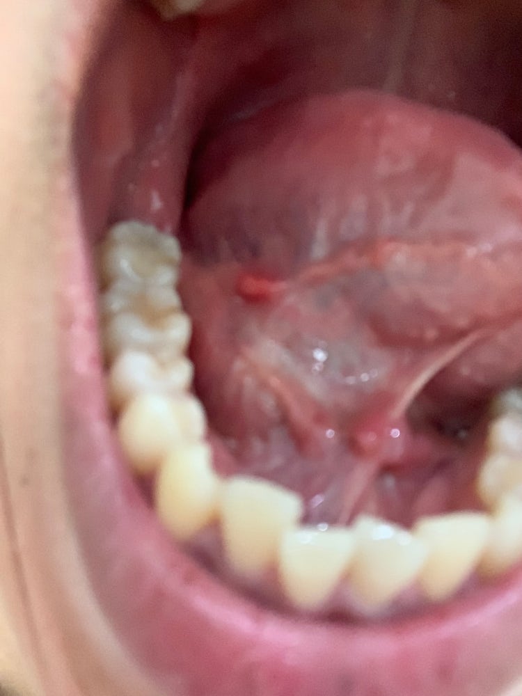 혀 밑 통증 : 지식iN