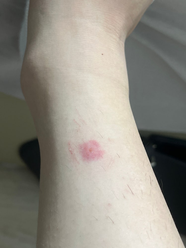 모기흉터? : 지식iN